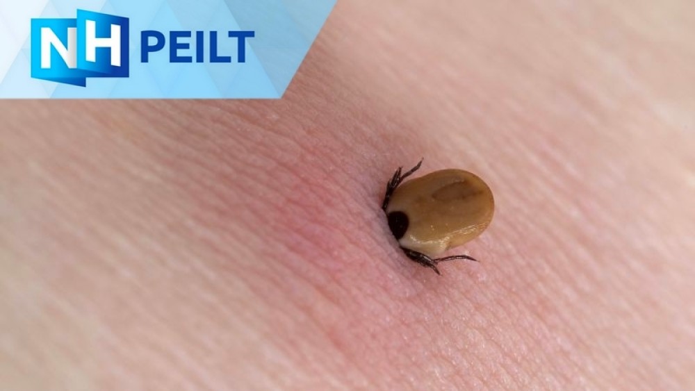 NH Peilt: Ziekmakende tekenbeet niet altijd te herkennen aan rode ring ...